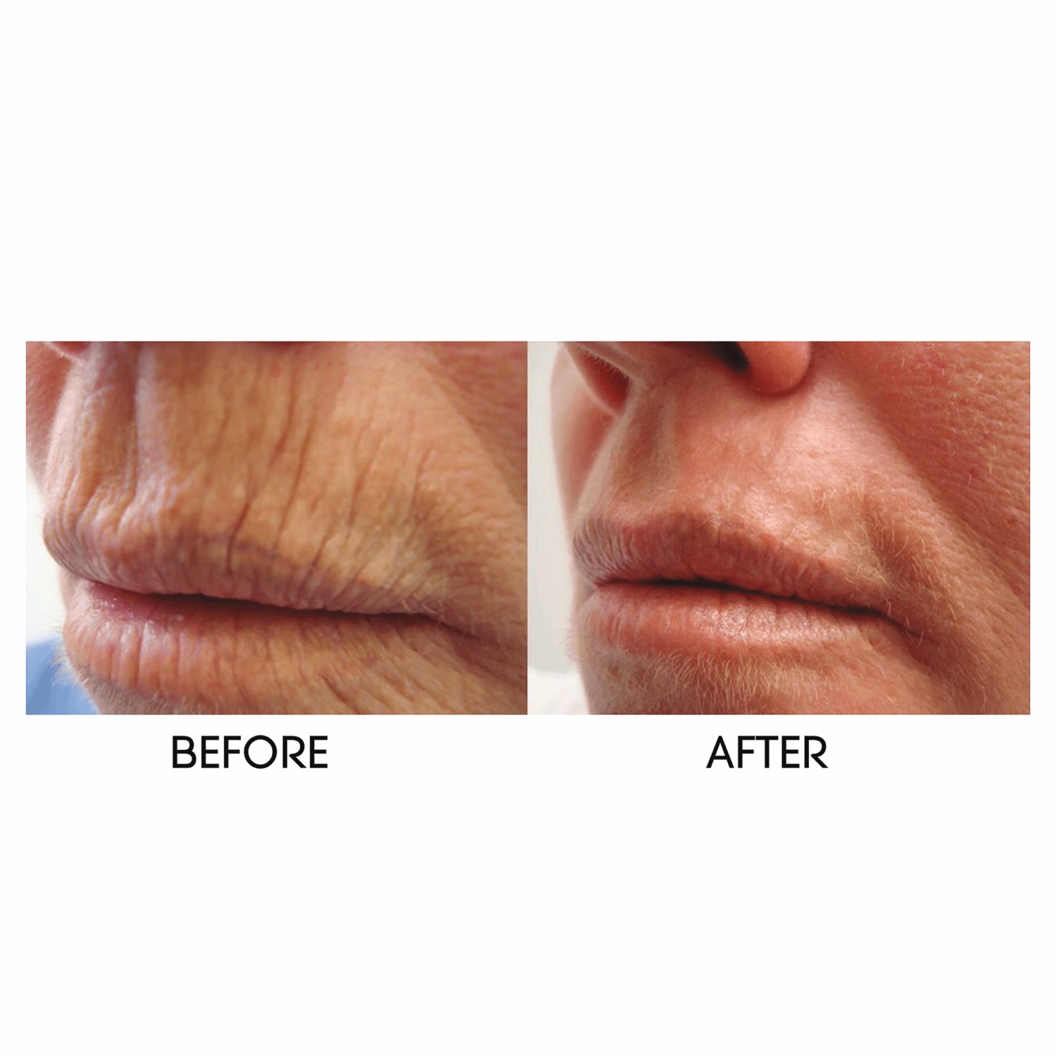 Lip Line Erasing Serum | Carol Wright