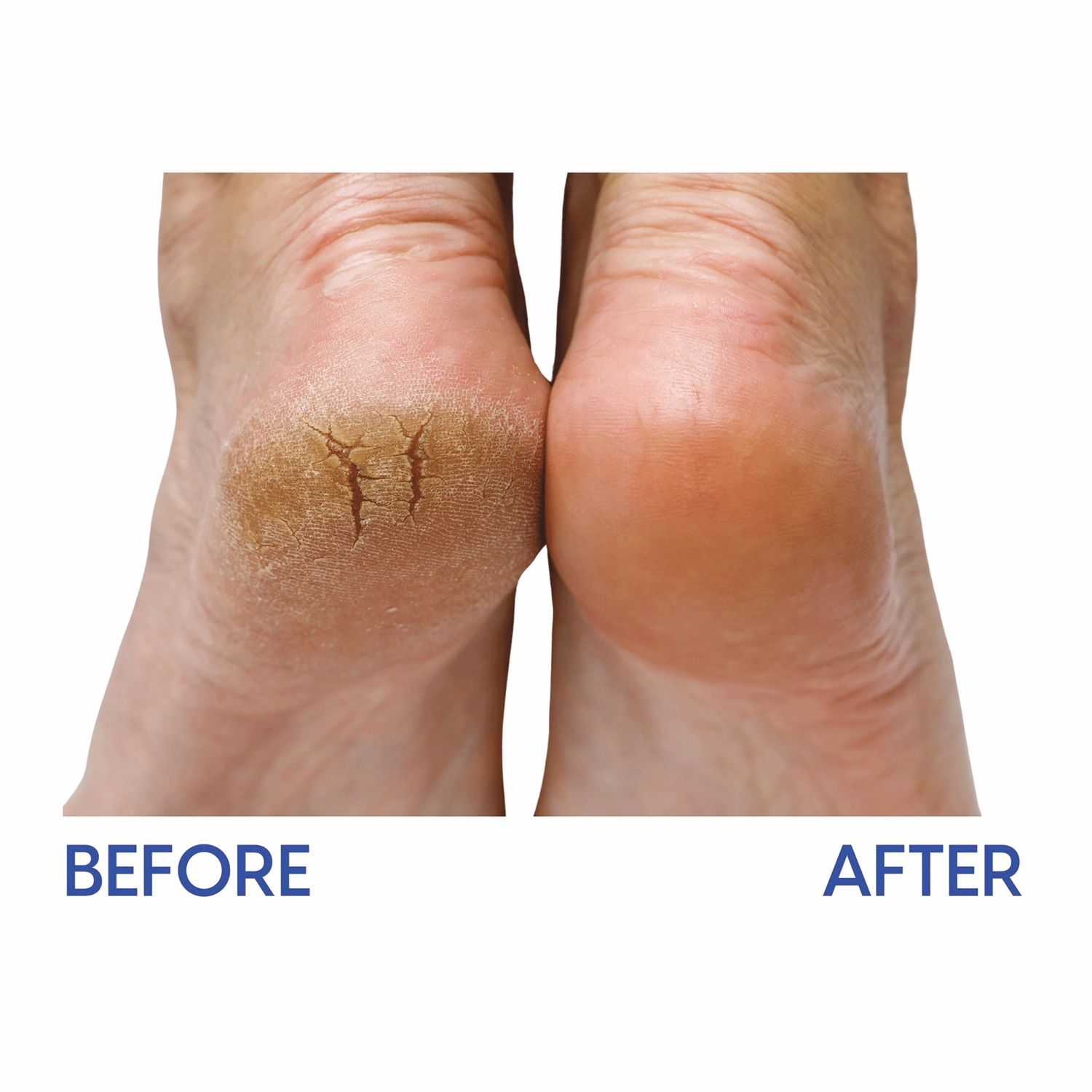 Relief Now Diabetic Dry Skin Relief Foot Cream | Carol Wright